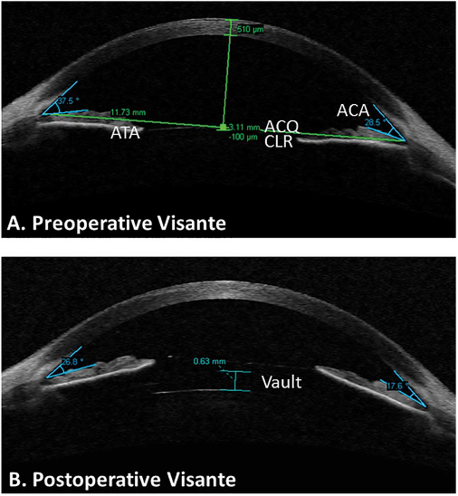 GitHub - ruipinge/icl-calc: Implantable Collamer Lenses (ICL) vault ...